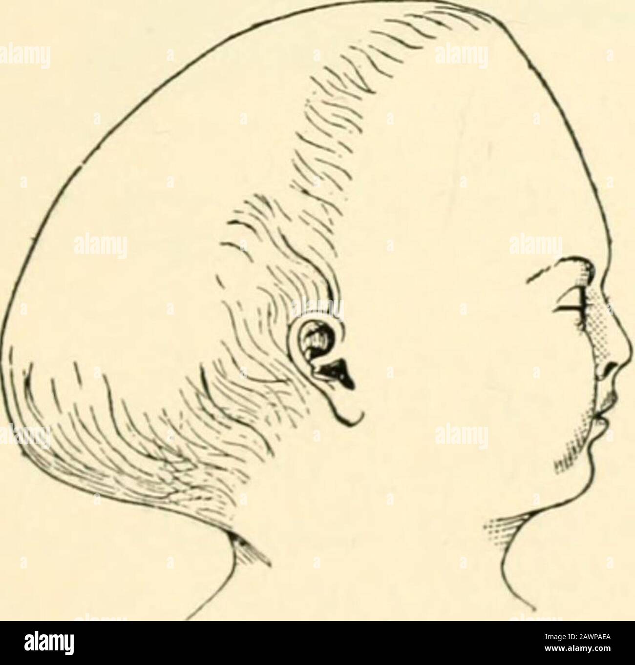 A textbook of obstetrics . Fig. 606.—Outline of head after de-livery ...