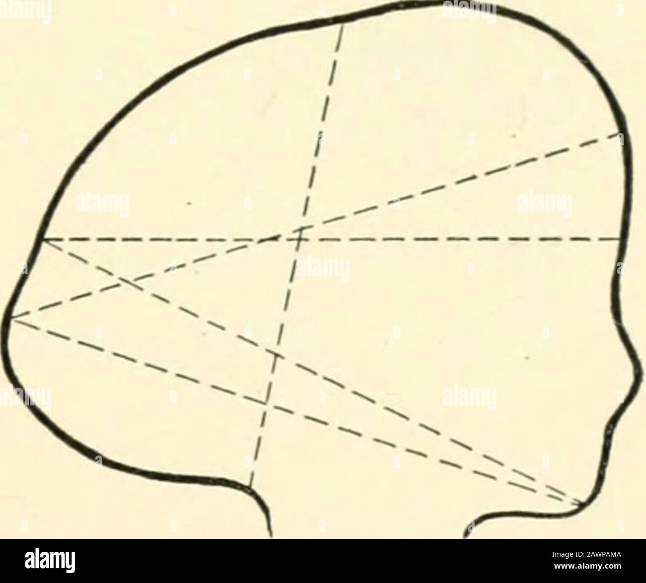 A textbook of obstetrics . Fig. 605.—Normal vertex (Schroeder).. Fig ...