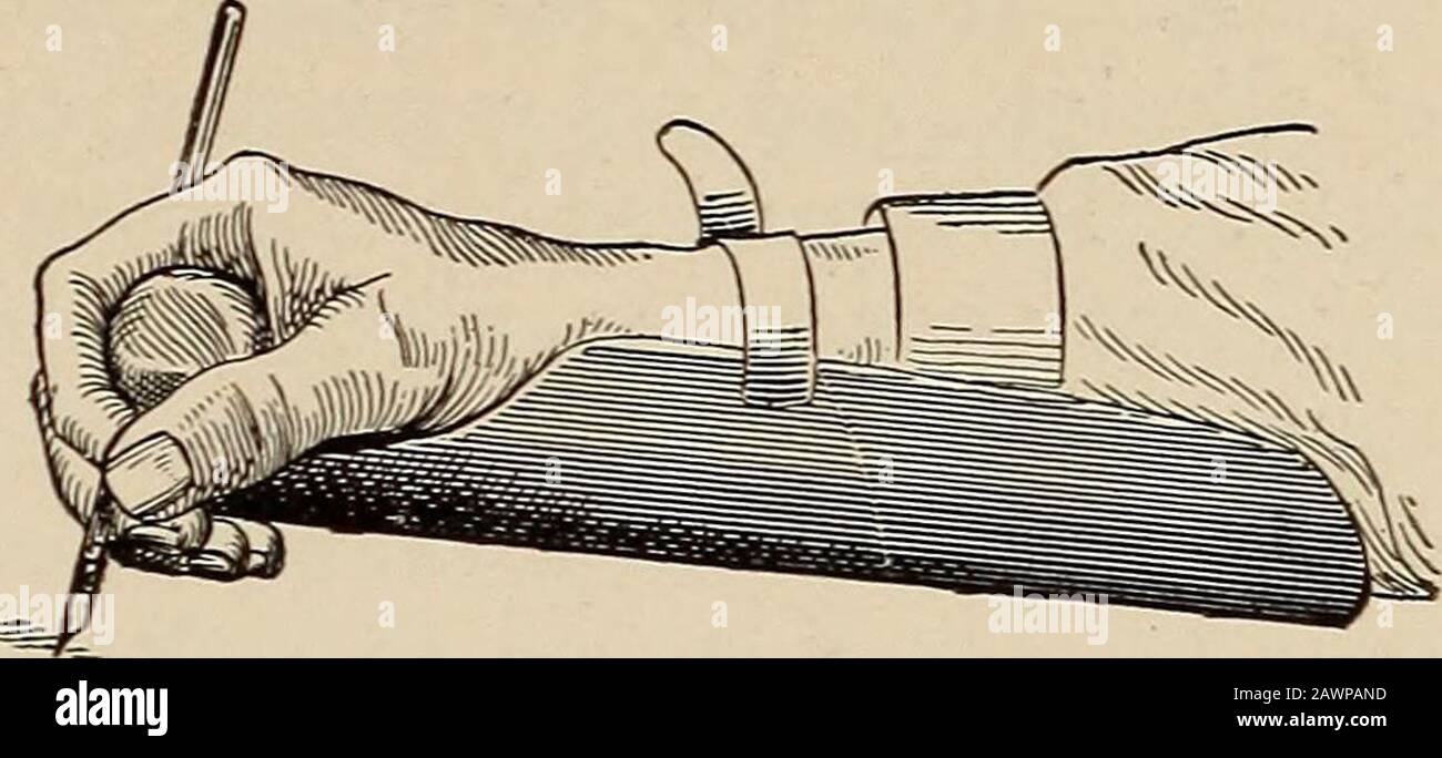 Nervous and mental diseases . Fig. 245.—1, Splint to immobilize hand ...