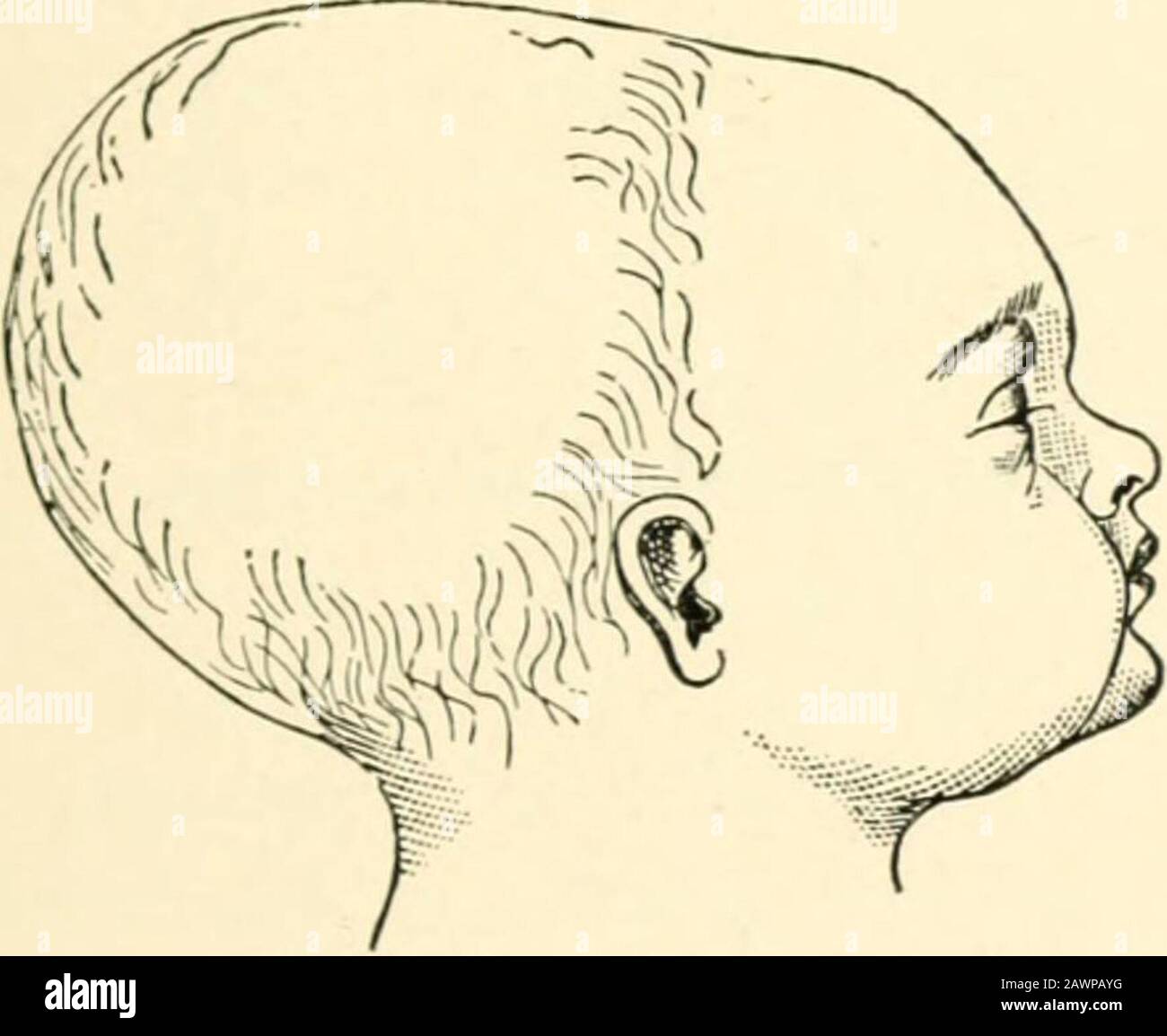 A textbook of obstetrics . Fig. 604.—Right occipito-posteriorposition ...