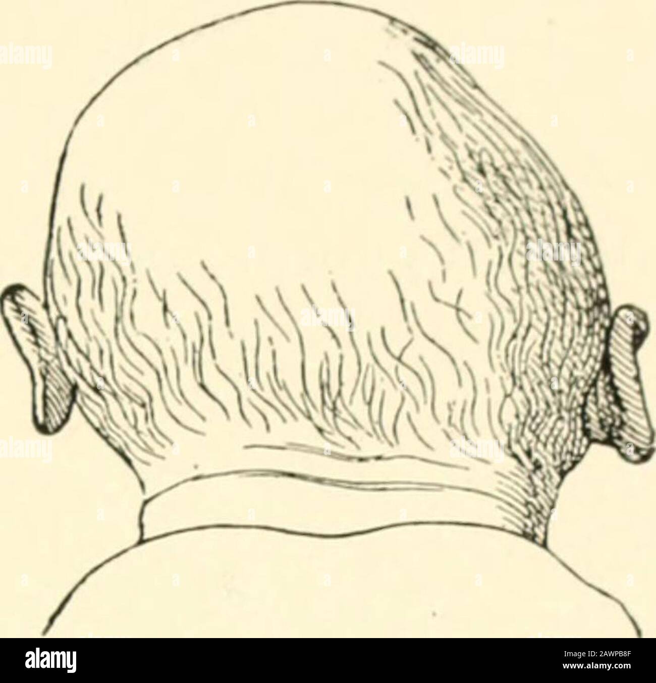 A textbook of obstetrics . Fig. 603.— The undistofted head of a breech ...