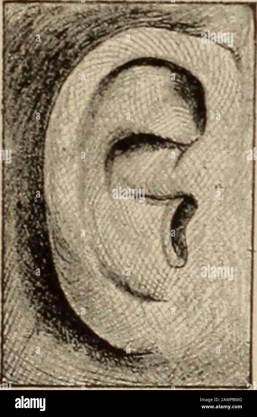 Nervous and mental diseases . Fig. 298.—No crus superius;no anthelix ...