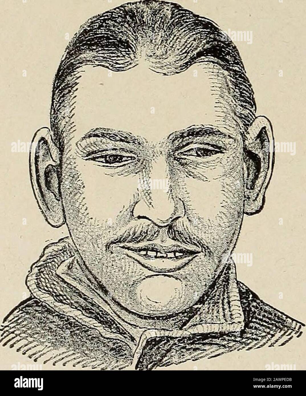 Nervous and mental diseases . Fossa scaphoidea Fig. 288.—Normal ear ...