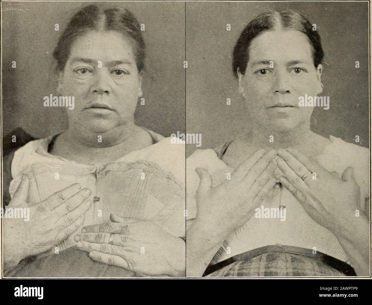 Panniculus hi-res stock photography and images - Alamy