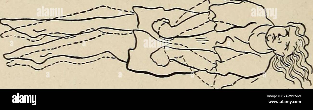 Nervous and mental diseases . Fig. 254.—Tonic phase, circumduction ...