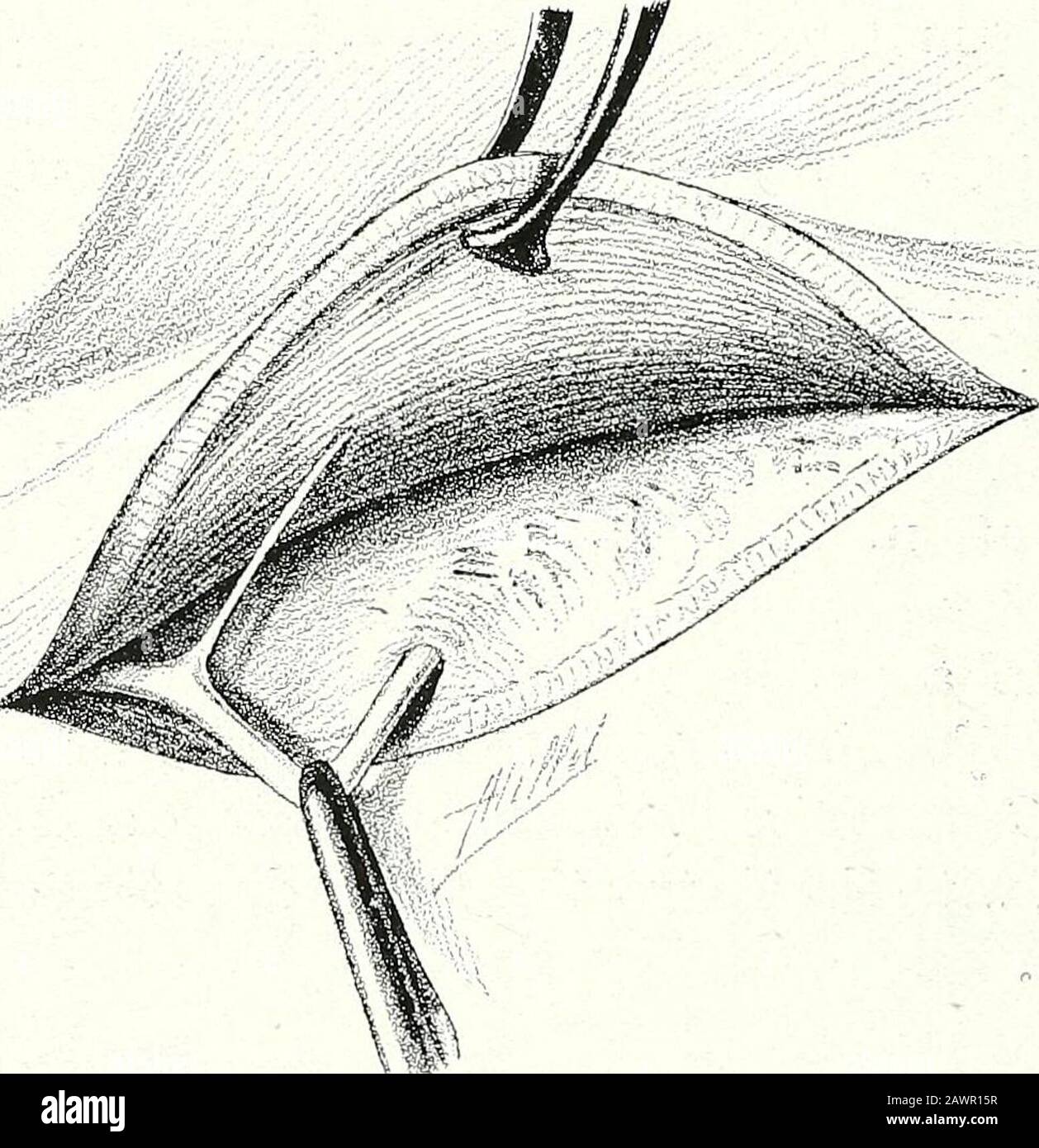 Surgical therapeutics and operative technique . Fig. 289.—Exposure and ...