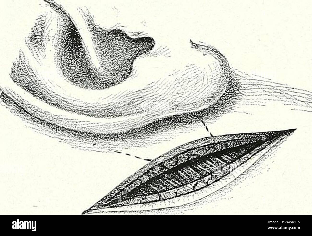 Tenotomy hi-res stock photography and images - Alamy