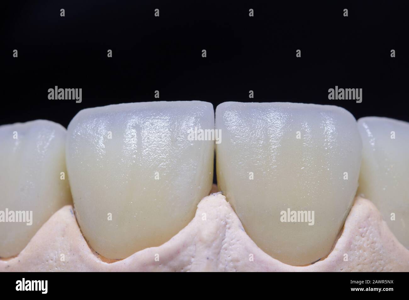 Orthodontic treatment hi-res stock photography and images - Alamy