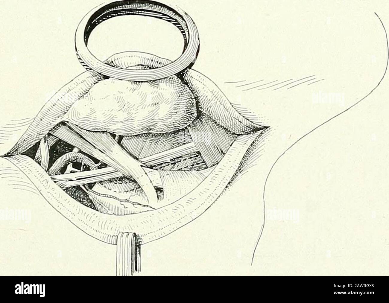 Surgical therapeutics and operative technique . Fig. 261.—^Ligature of ...