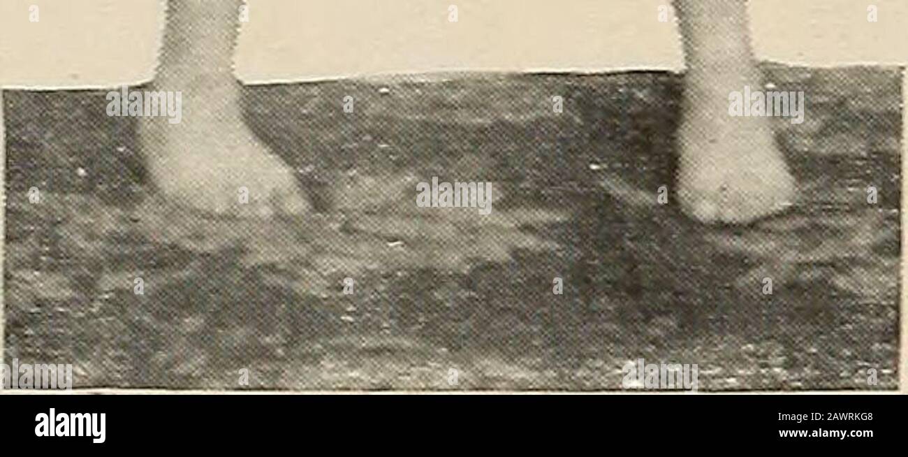 Nervous and mental diseases . n . ***°^ -N». Fig. 174.—Showing attitude ...