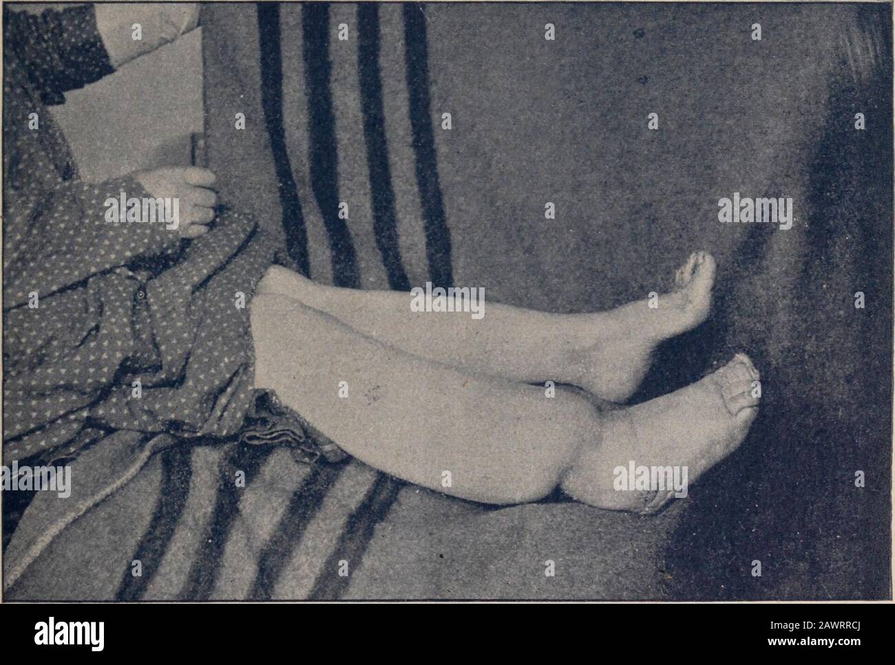 Elephantiasis hospital hi-res stock photography and images - Alamy