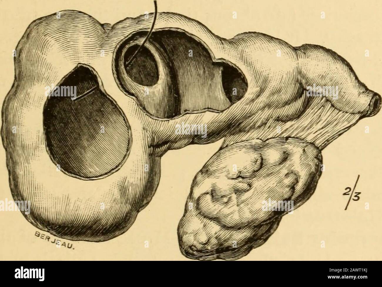 Hydrosalpinx hi-res stock photography and images - Alamy