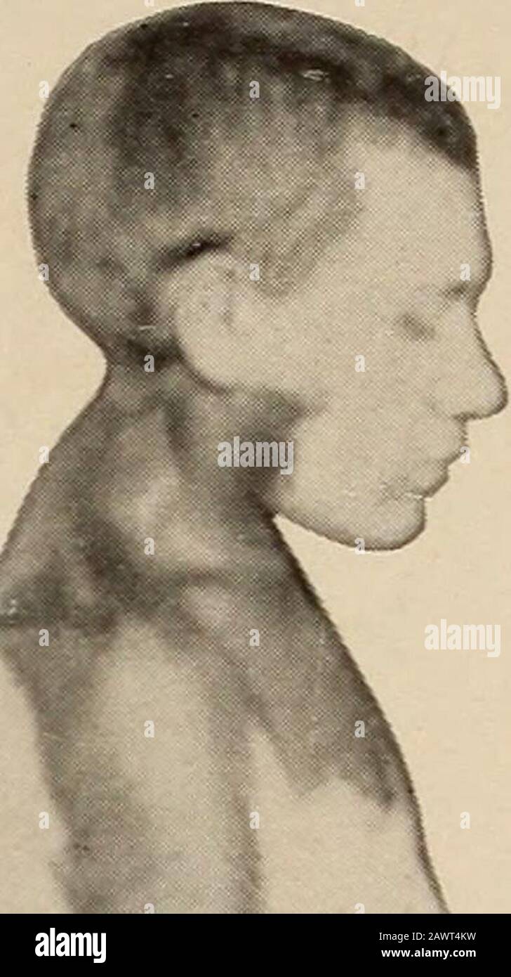 Nervous and mental diseases . Figs. 145 and 146.—Sections of two ...