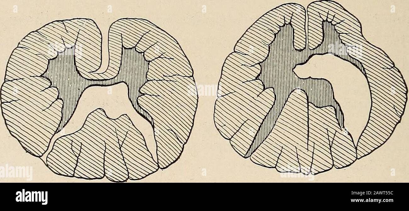 Nervous and mental diseases . Fig. 144.—Sections of a syringomyelic ...