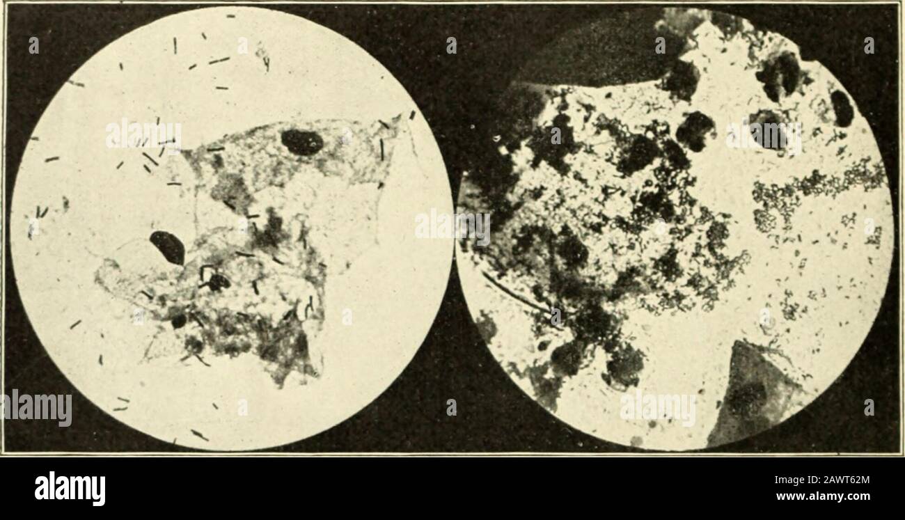 A textbook of obstetrics . vaginal secretions, except a thrush ...