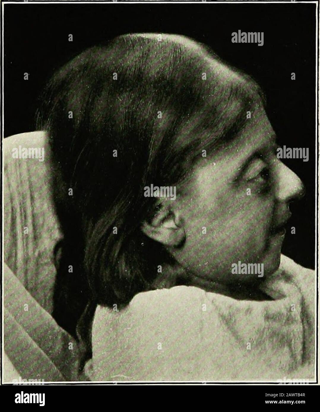 The medical diseases of children . epiphyses. Nodules of callus on the ...