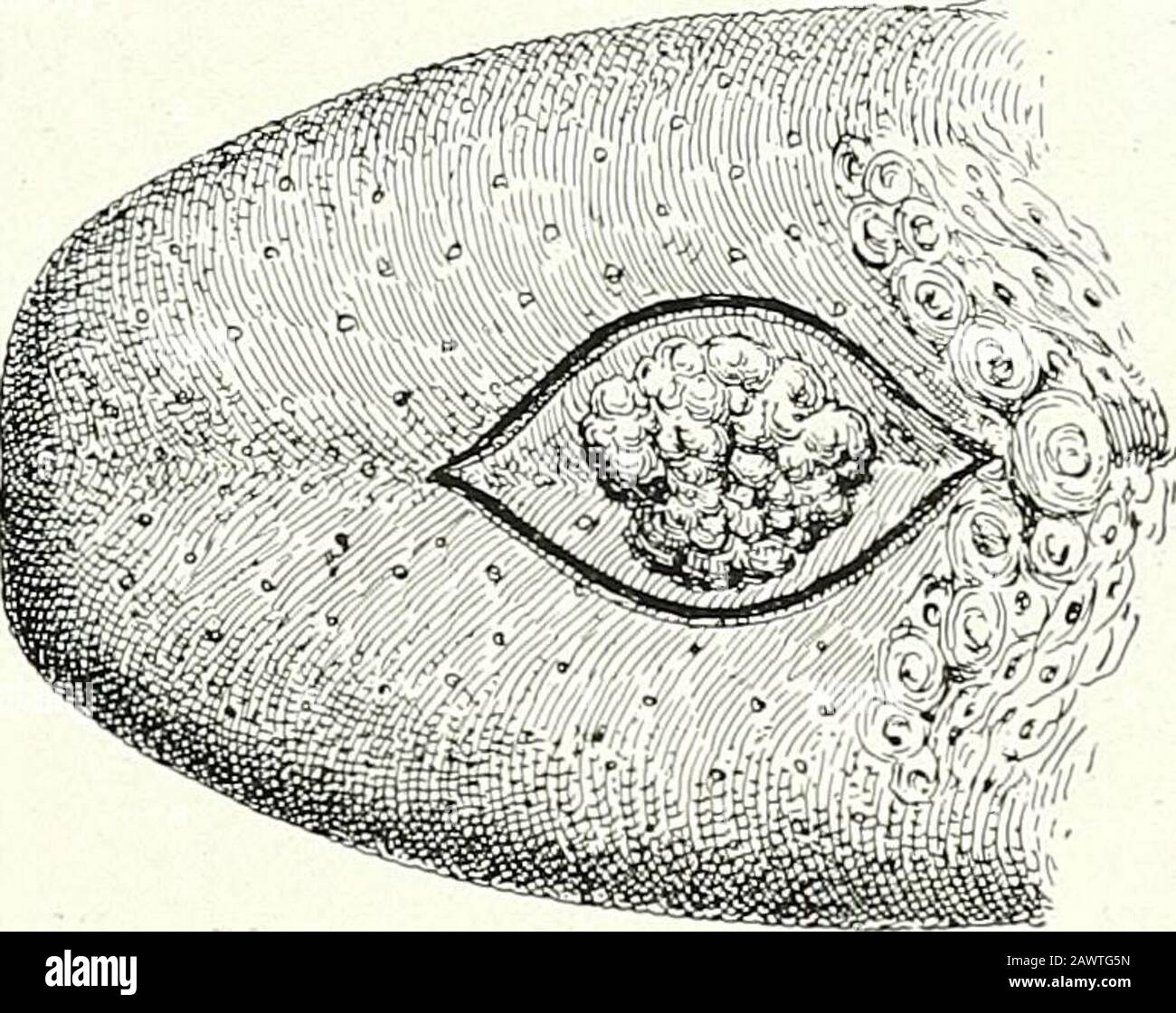 Surgical therapeutics and operative technique . mplicated with the ...