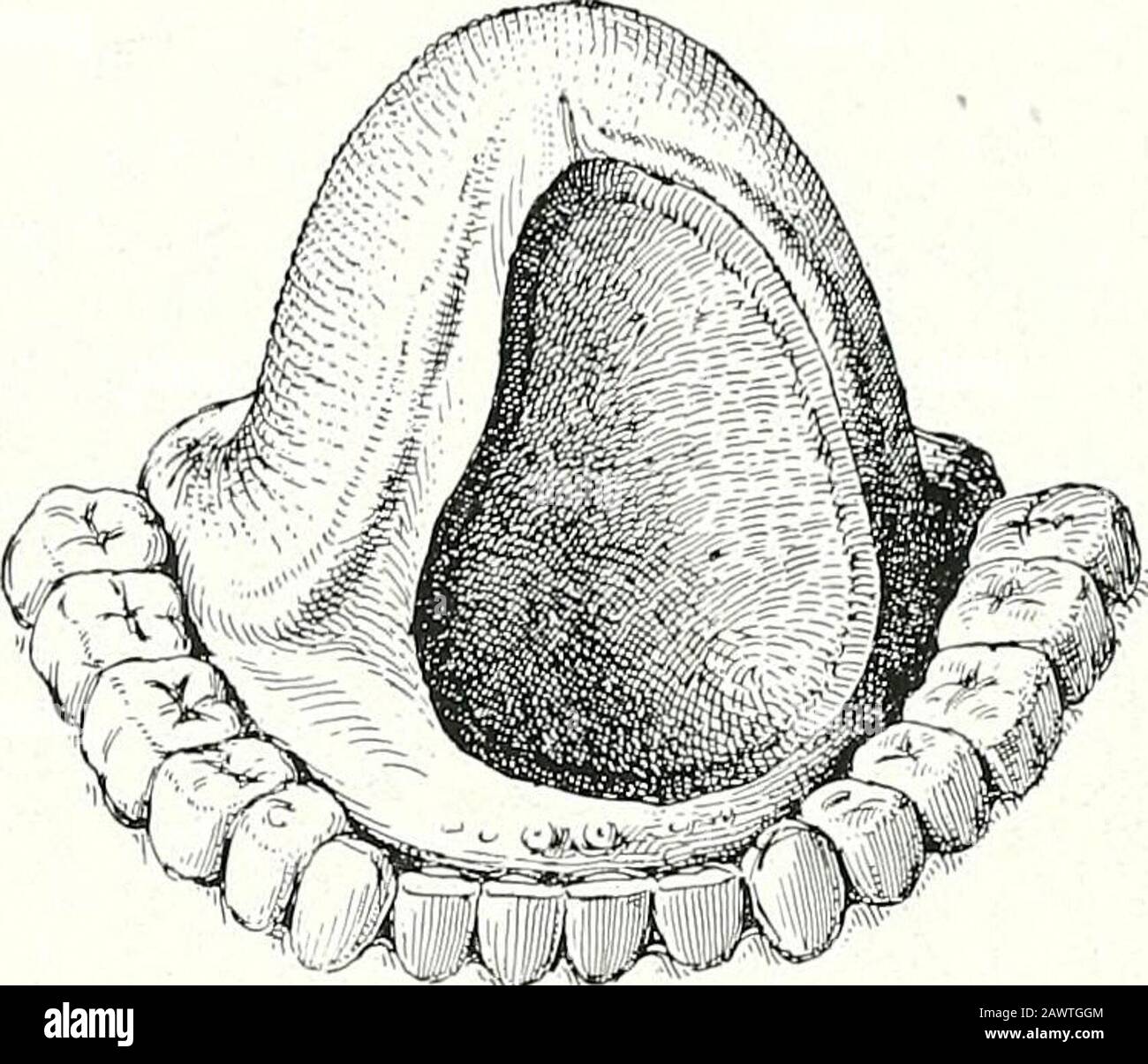 Surgical therapeutics and operative technique . Fig. 214.—Ranula of ...