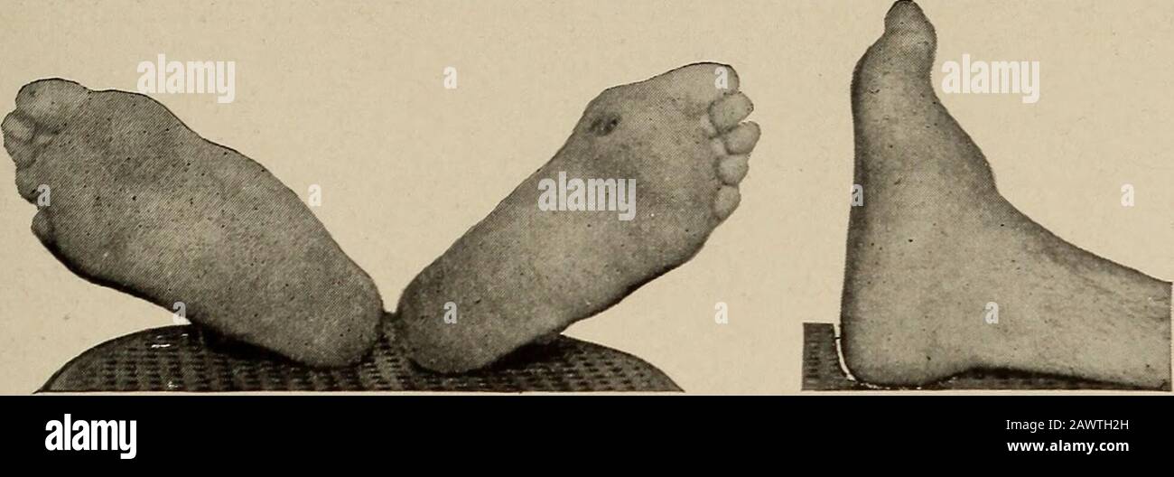 Nervous and mental diseases . Fig. 194.—Tabetic arthrop-athy of right ...