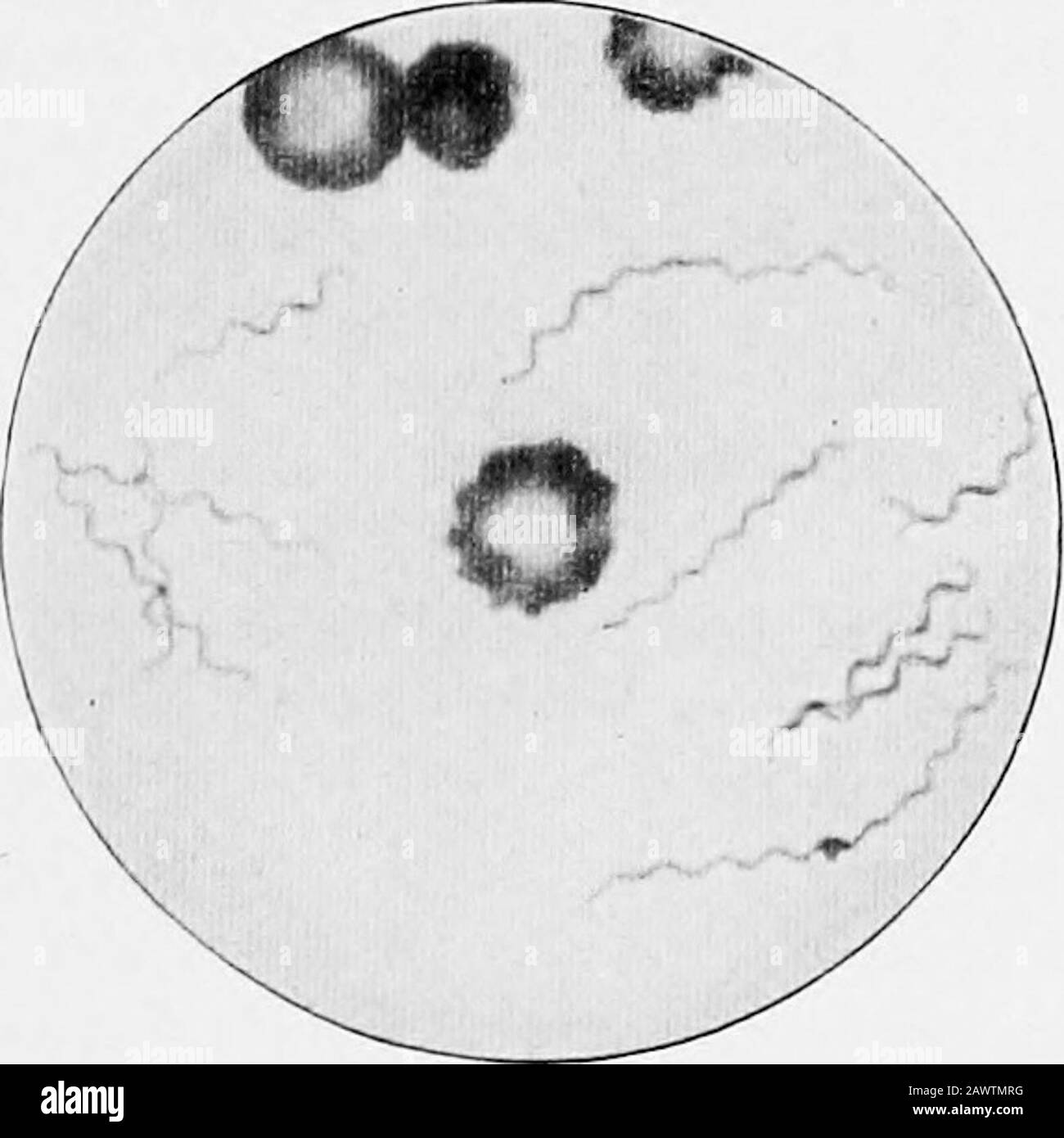 Tertiary syphilis hi-res stock photography and images - Alamy