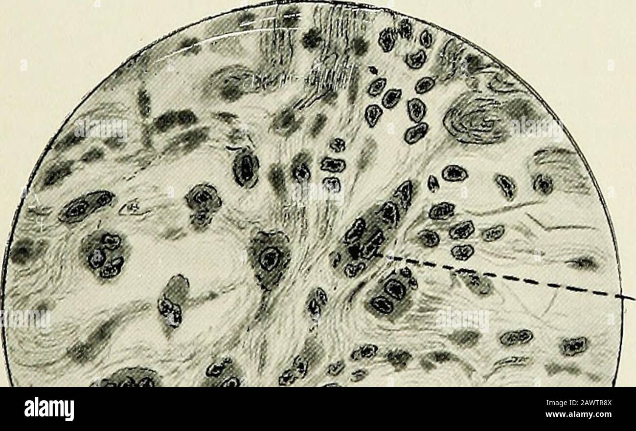 The medical diseases of children . Fig. 61.—Rheumatic Myocarditis. A ...