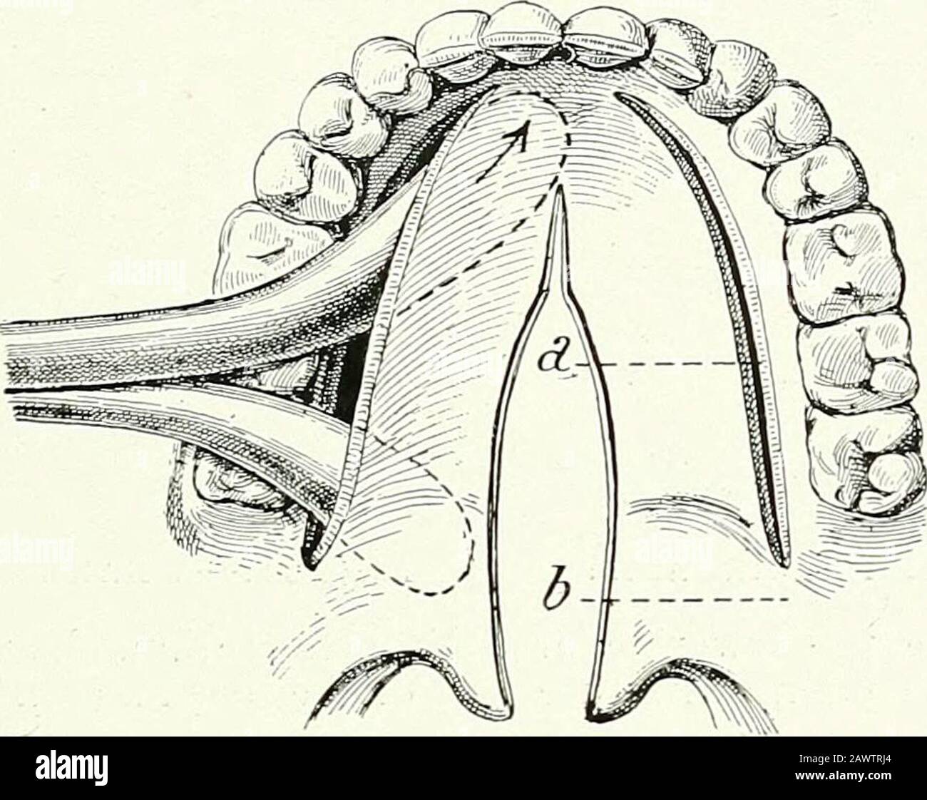 Surgical therapeutics and operative technique . la; two raspatories ...