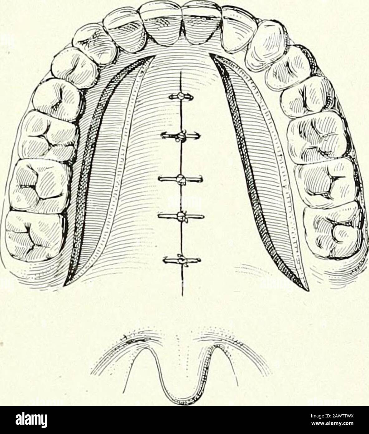 Surgical therapeutics and operative technique . Fig. 194. -Median ...