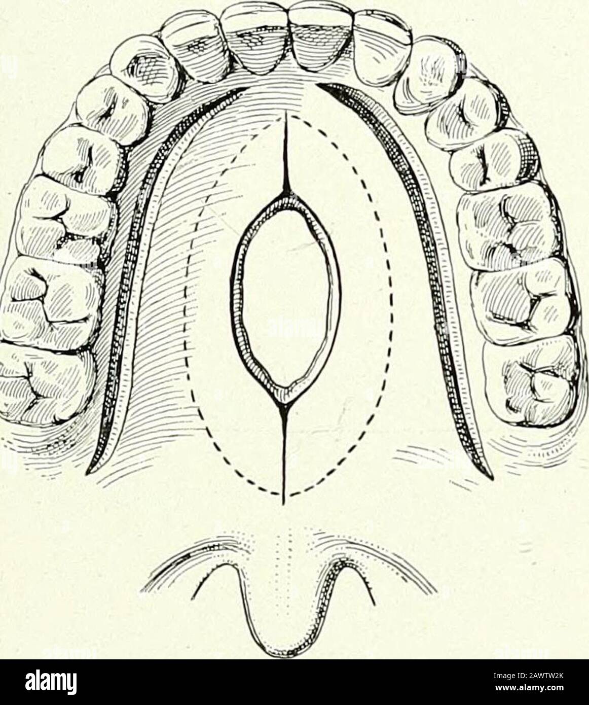 Inferior dental nerve hi-res stock photography and images - Alamy