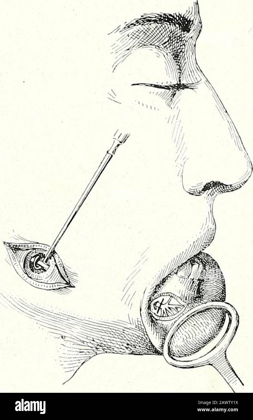 Surgical therapeutics and operative technique . Fio. 191.—Resection of ...