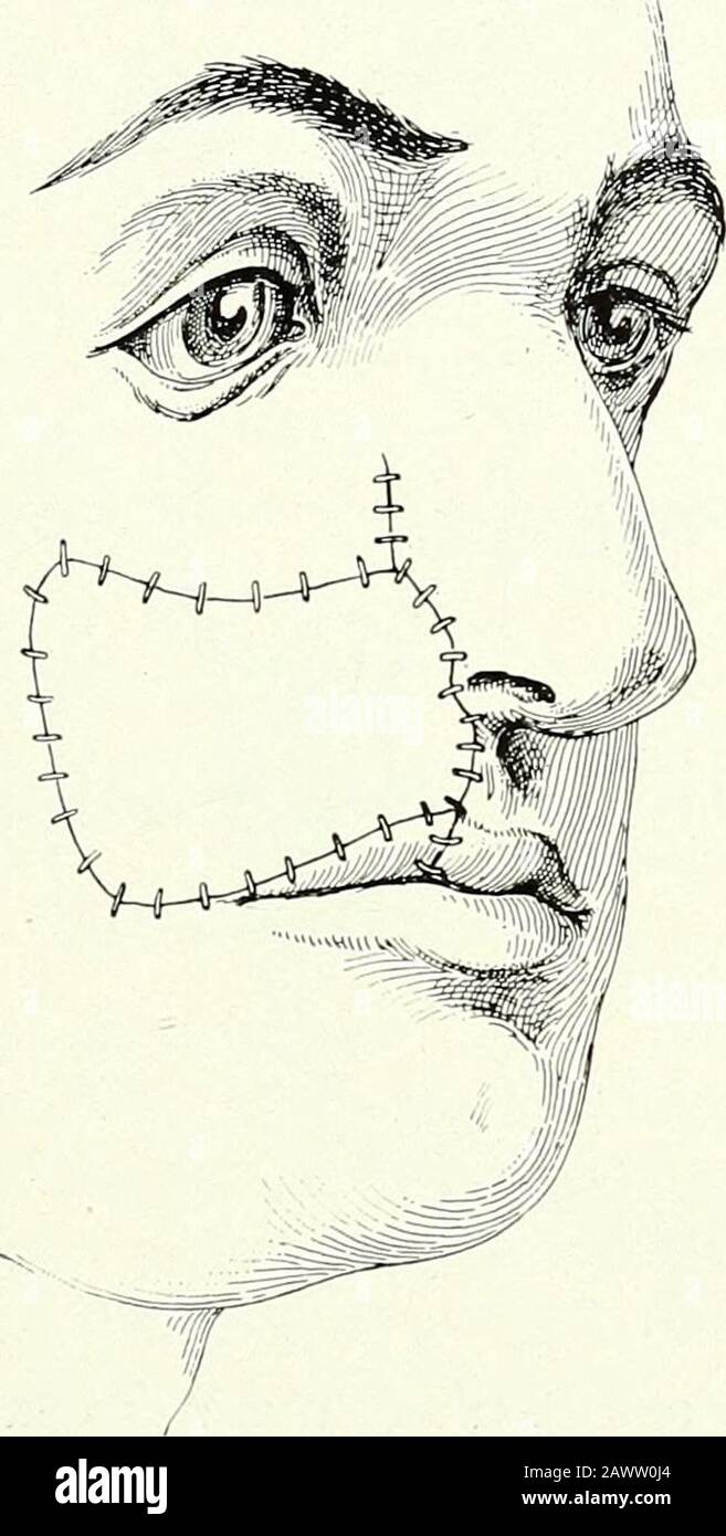 Surgical therapeutics and operative technique . Fjg. 188 ...