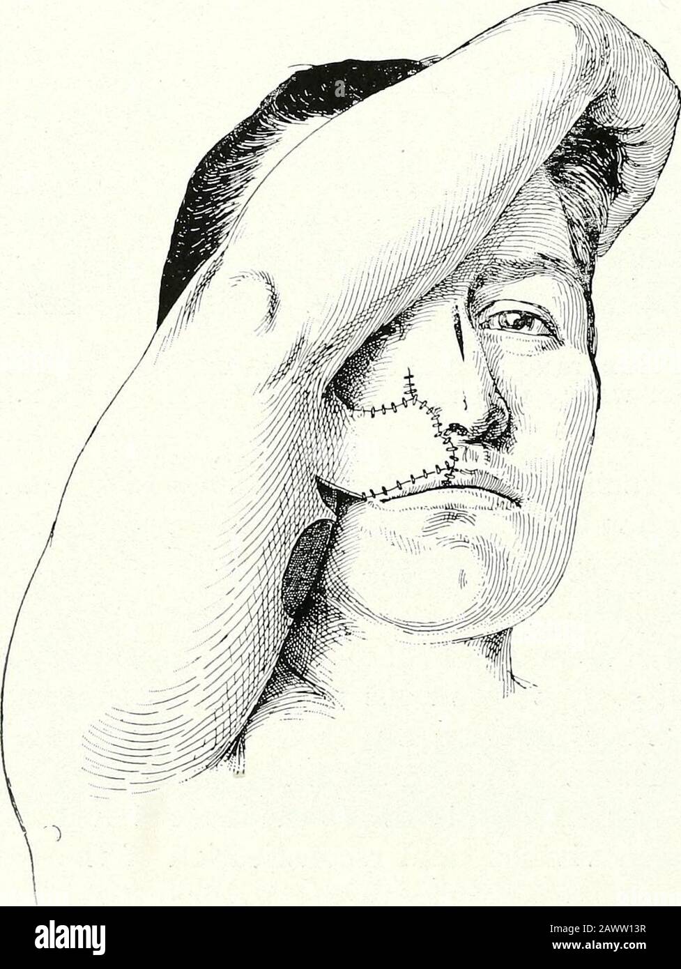 Surgical therapeutics and operative technique . Fig. 187 ...
