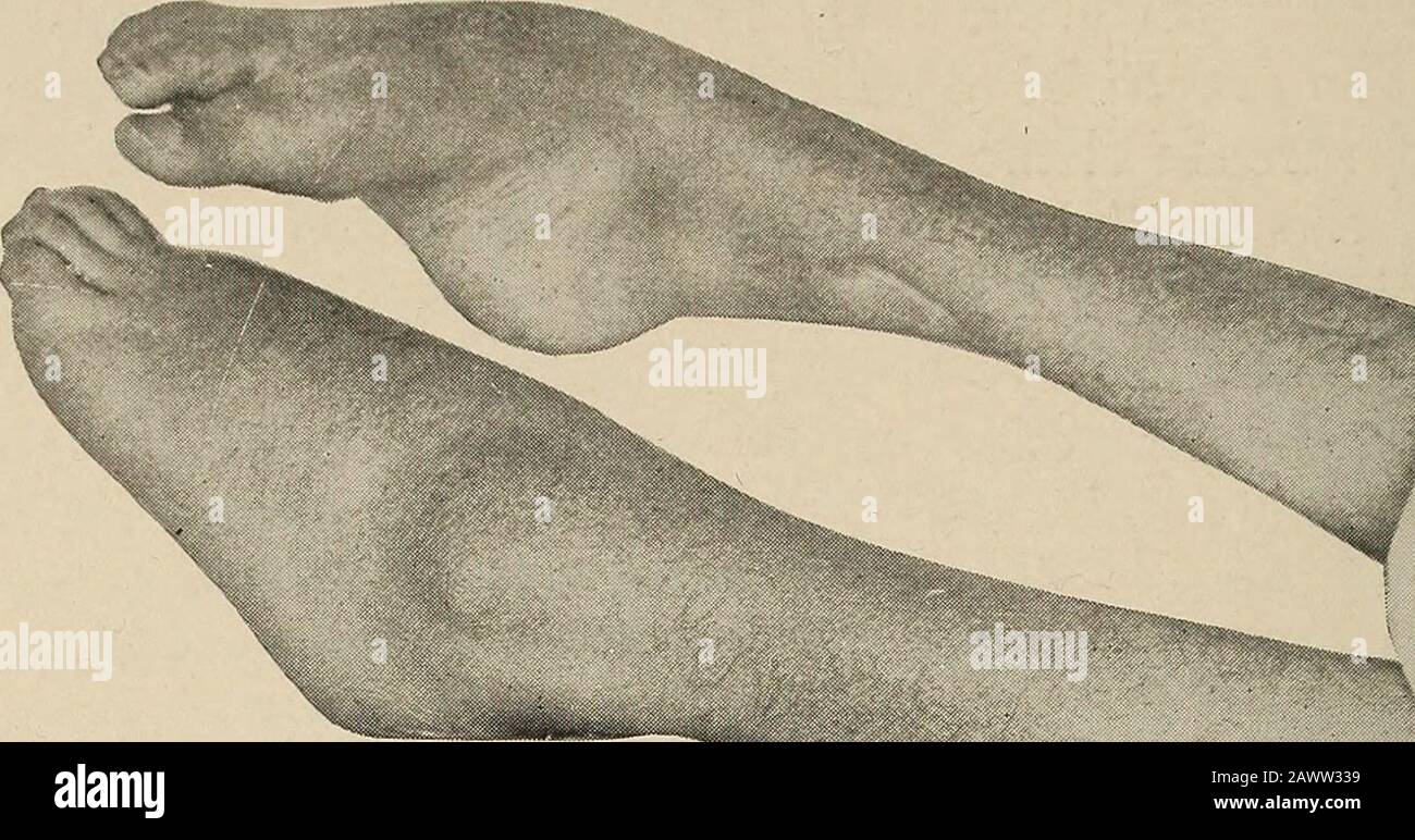 Nervous and mental diseases . right angle. The toes remain in a flexed ...