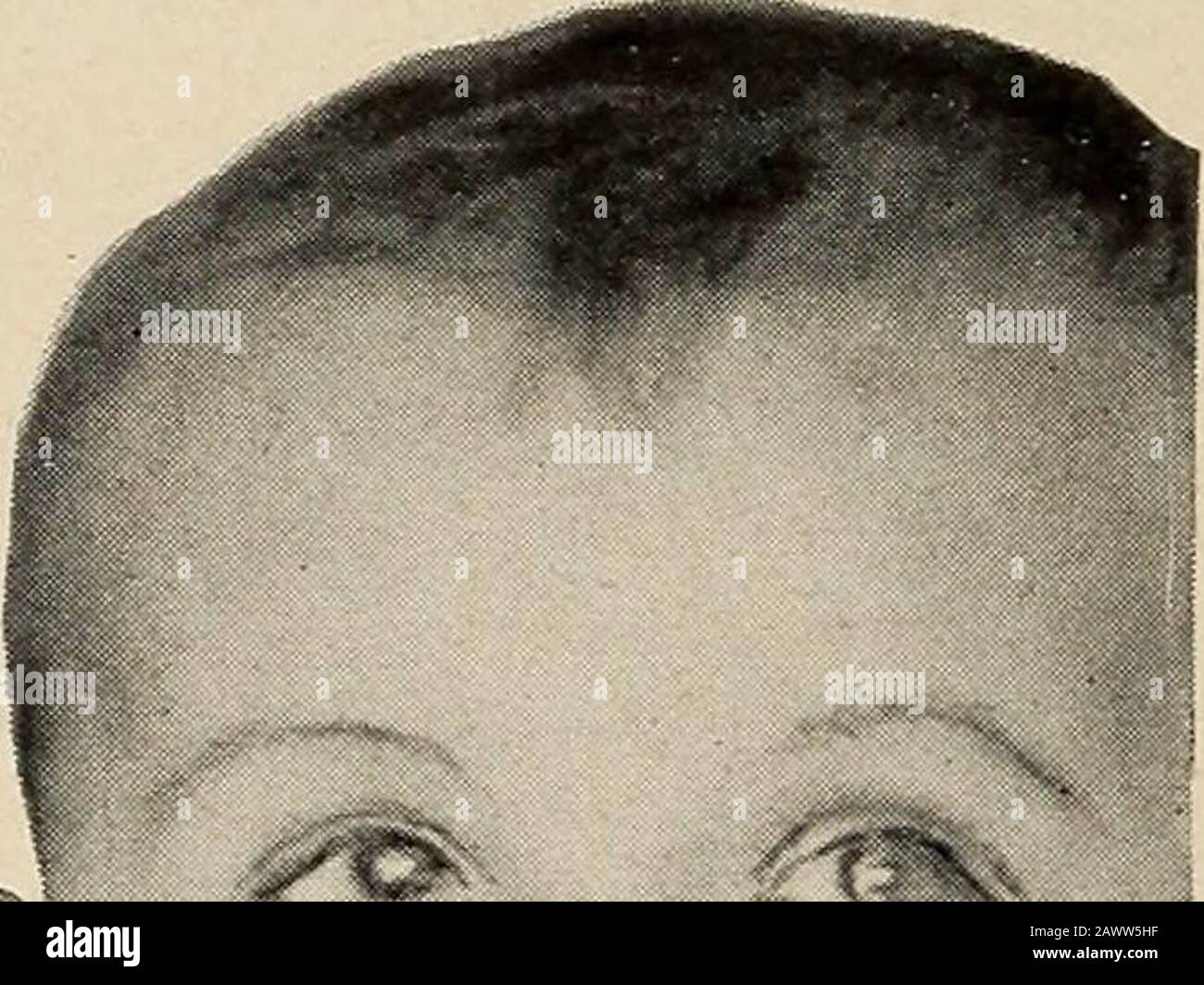 Nervous and mental diseases . a hook over the neck orin the axilla ...