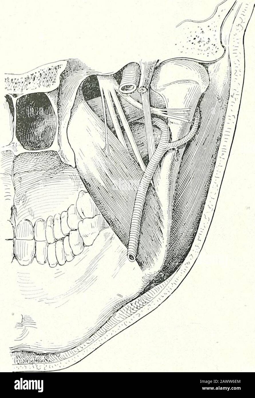 Surgical therapeutics and operative technique . Fig 17!».—Unilateral ...