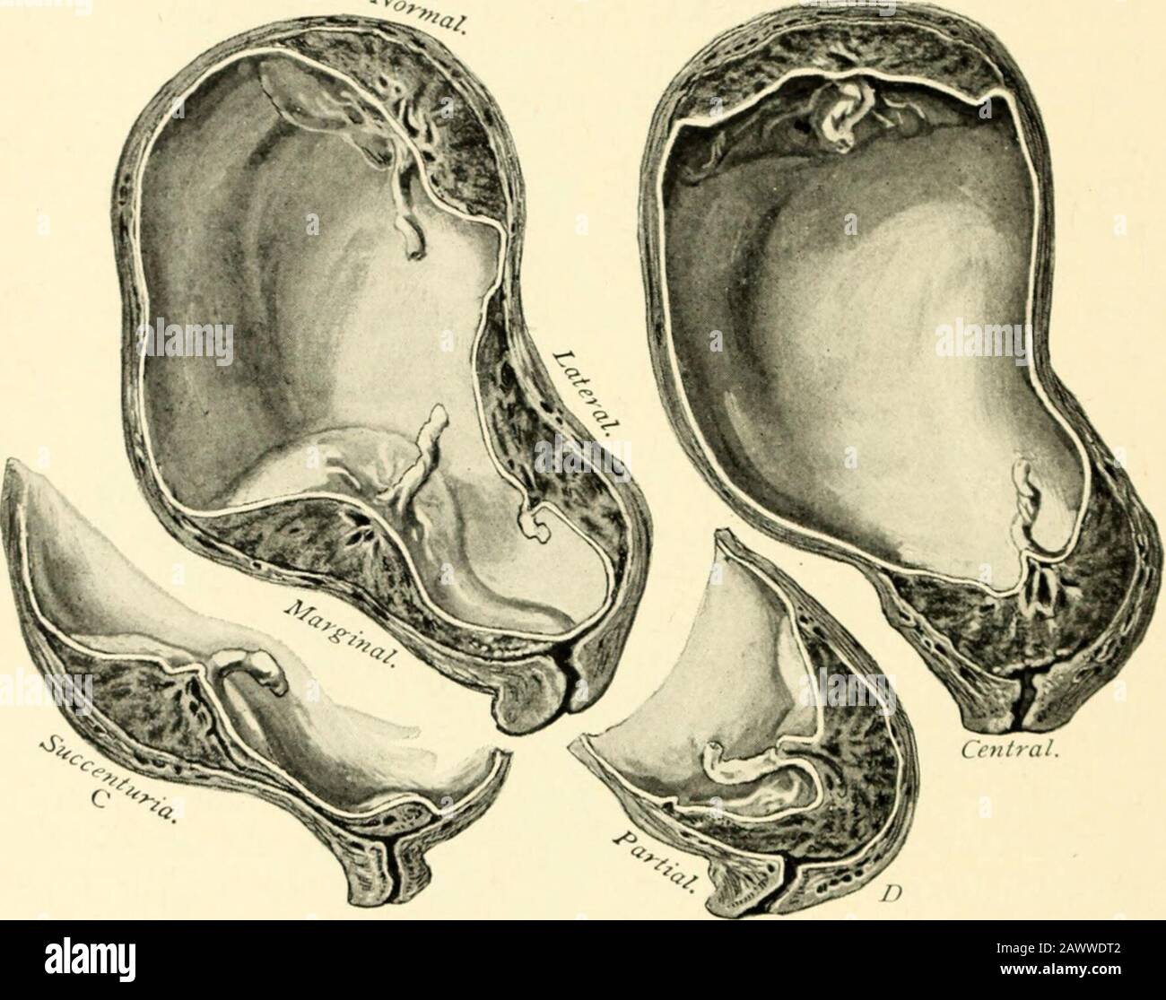 Placenta praevia hi-res stock photography and images - Alamy