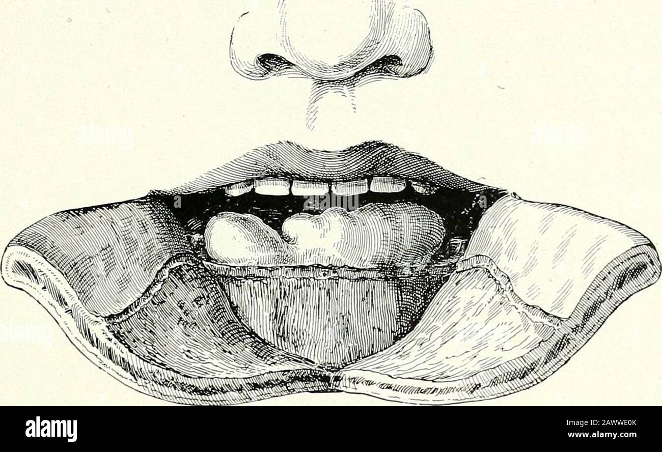 Surgical therapeutics and operative technique . Fig. 168.—Partial ...