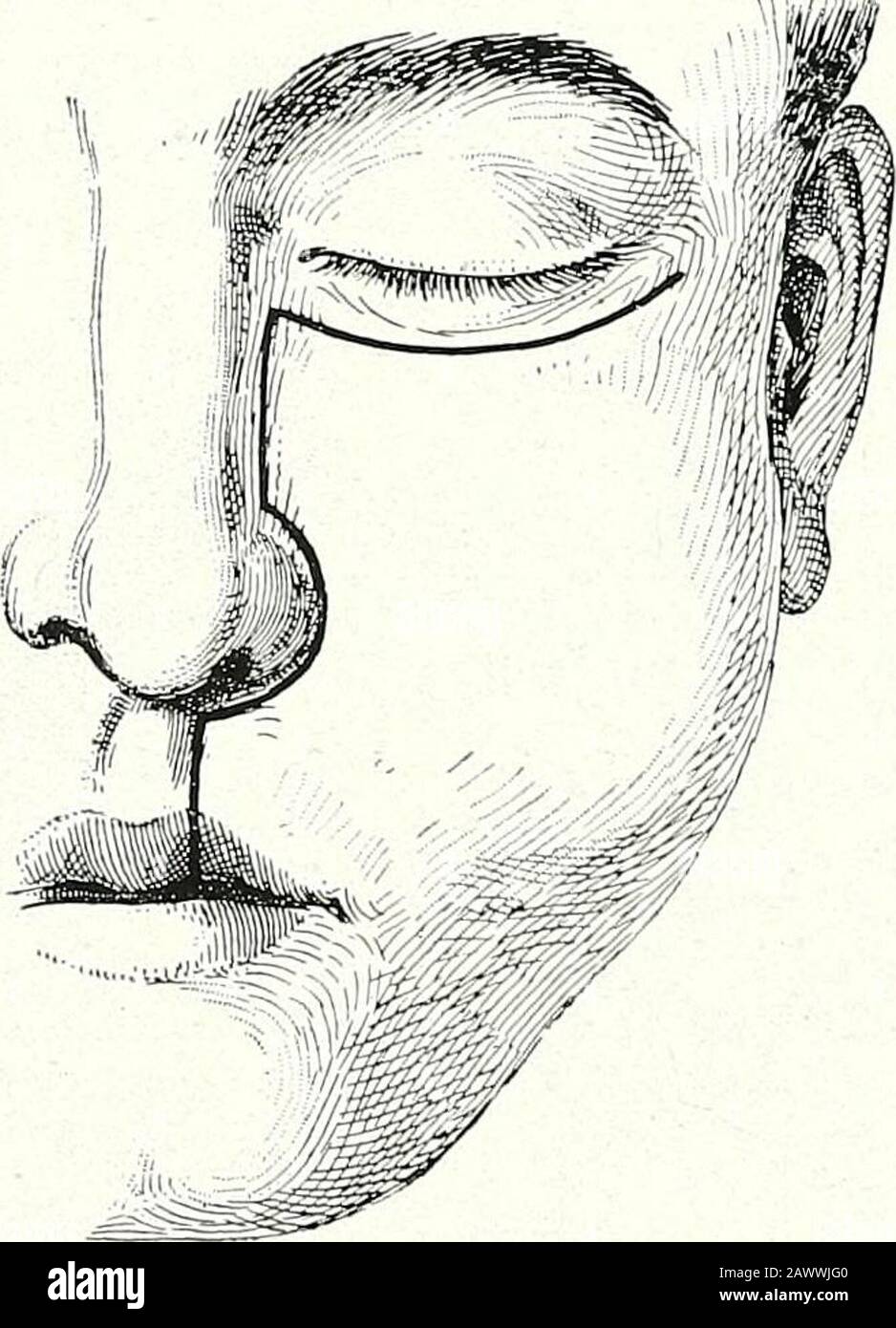 Surgical therapeutics and operative technique . tial Resection of the ...