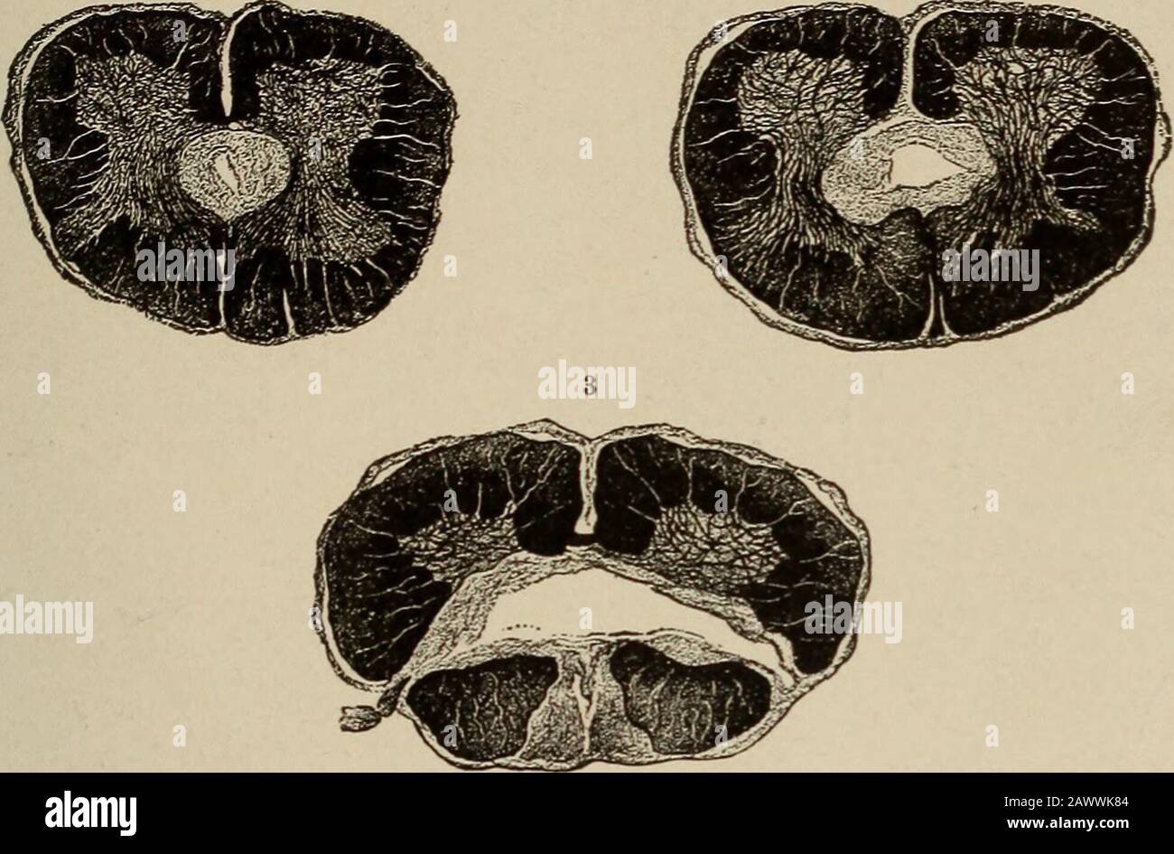 Syringomyelia Cross Section