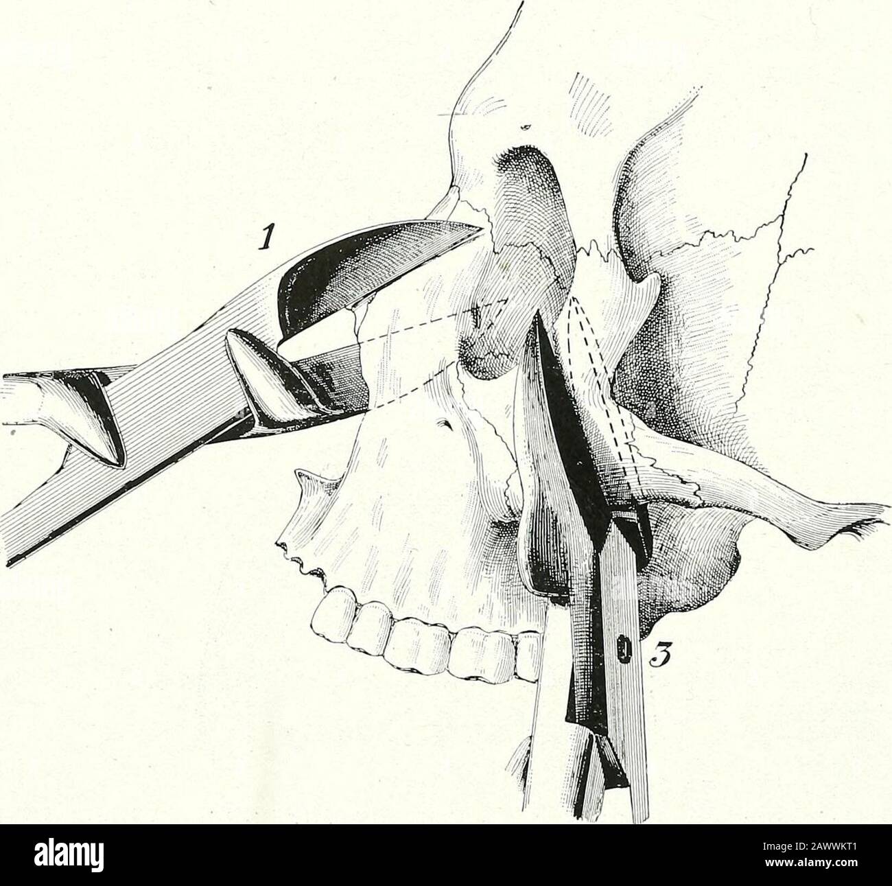 Surgical therapeutics and operative technique . Fig. 154.—Diagram of ...