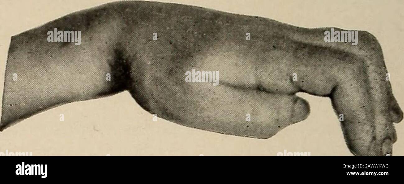 Contractures hi-res stock photography and images - Alamy