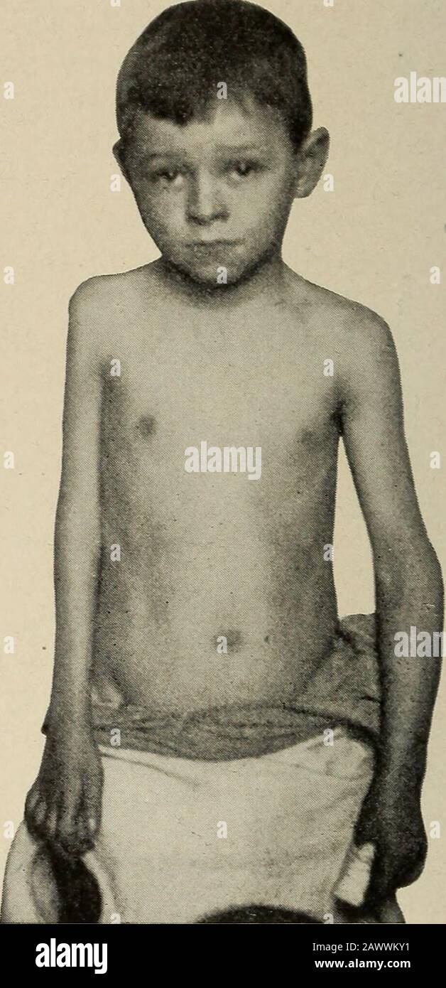 Poliomyelitis anterior acuta hi-res stock photography and images - Alamy