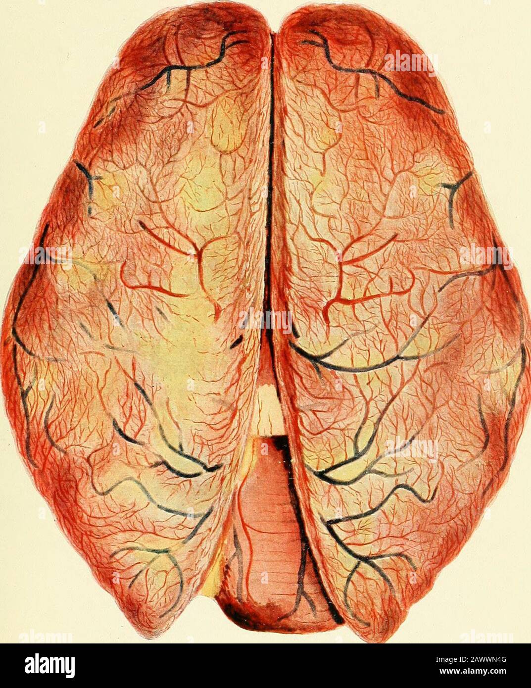 Pus brain hi-res stock photography and images - Alamy