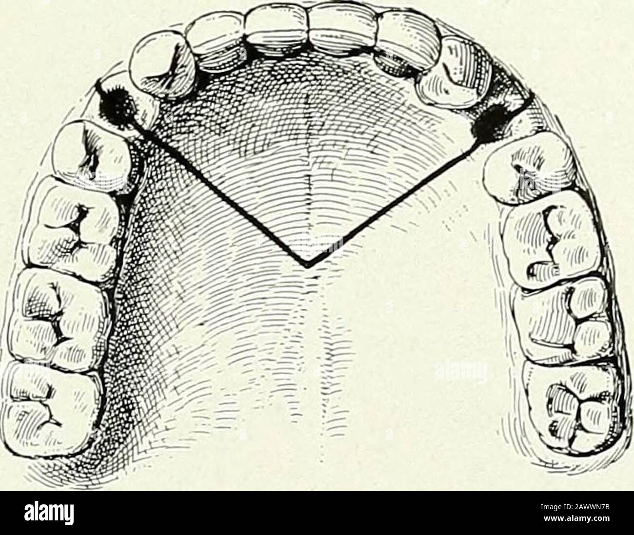 Surgical therapeutics and operative technique . Fig. 152.—Sarcoma of ...