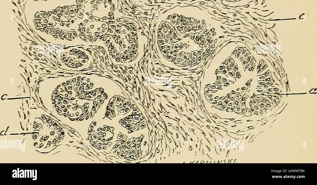 Treatise on gynæcology : medical and surgical . superficial forms ...
