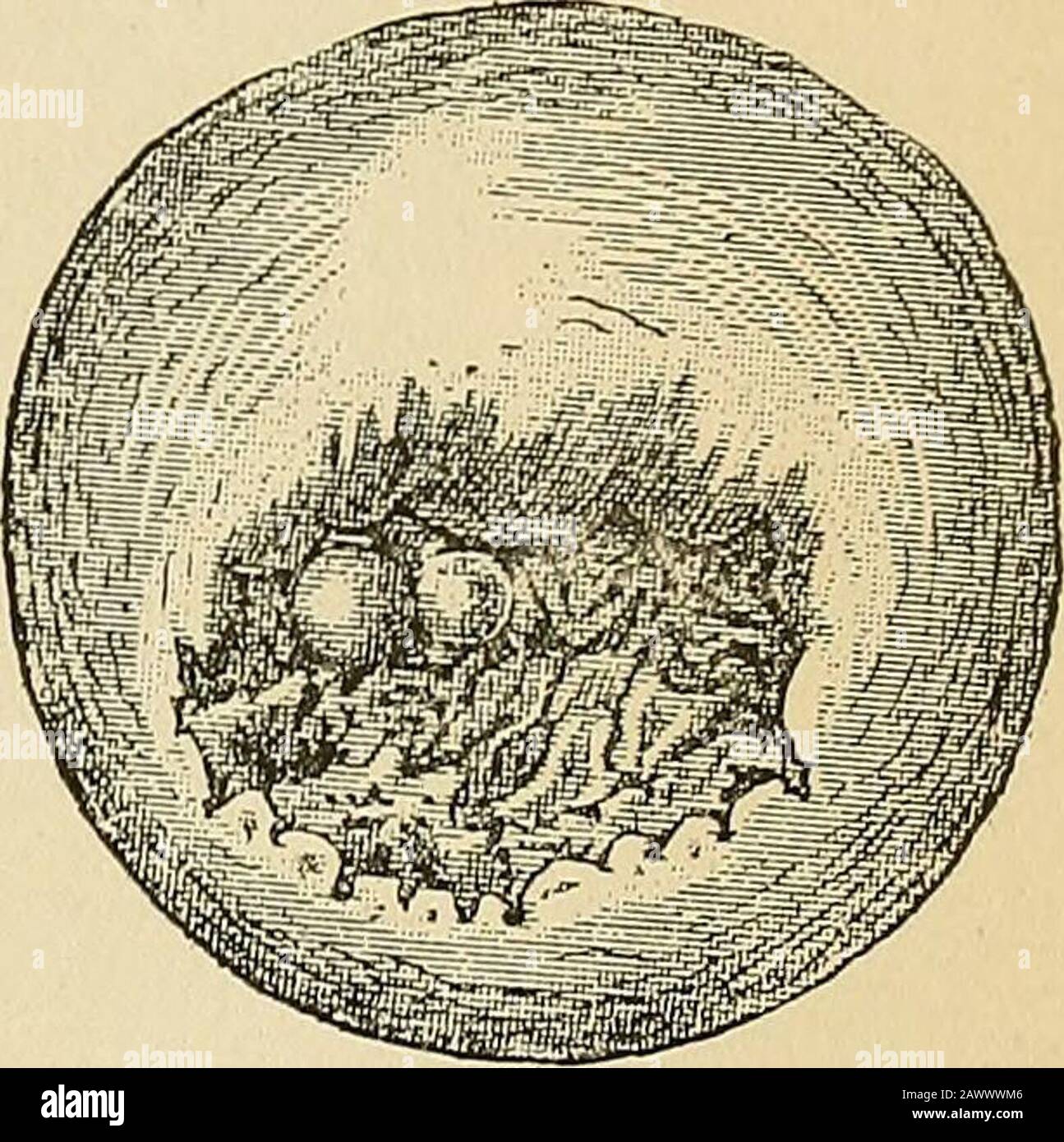 Treatise on gynæcology : medical and surgical . Fig. 168.—Cancer of the ...