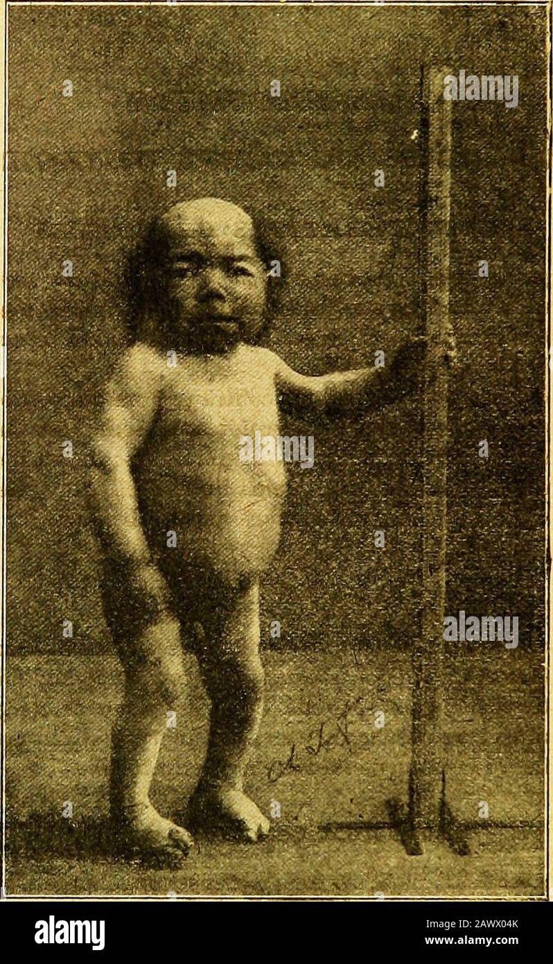 Cretinisme hi-res stock photography and images - Alamy