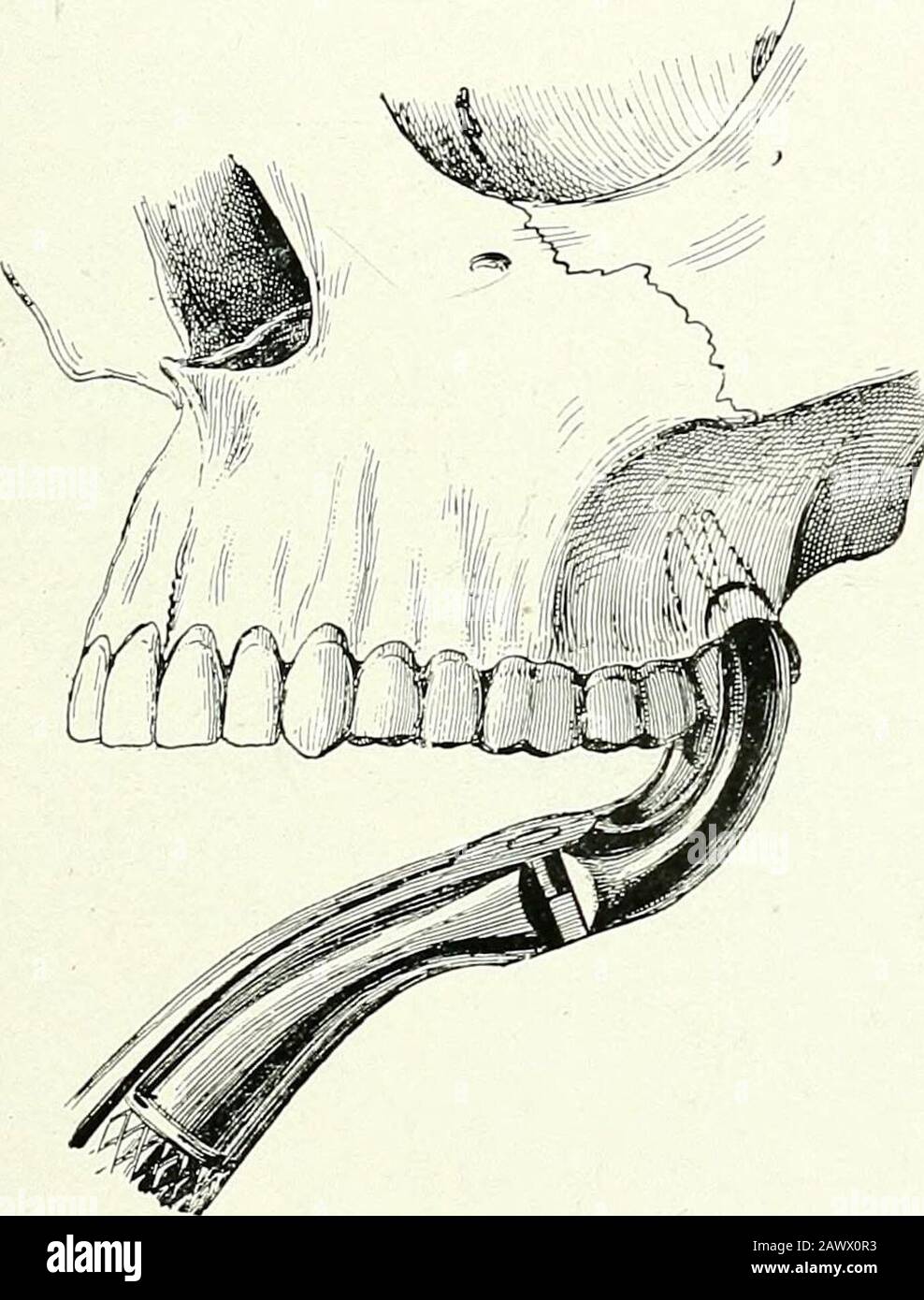 Surgical therapeutics and operative technique . Fig. 139.—Extraction of ...