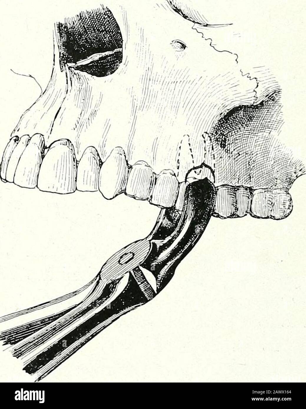 Surgical therapeutics and operative technique . Fig. 137.—Ablation of ...