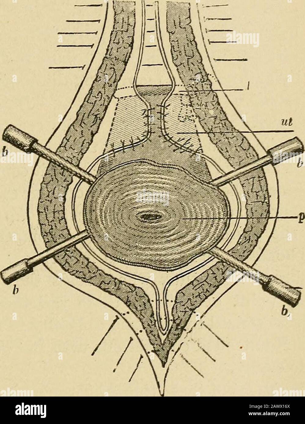 Treatise on gynæcology : medical and surgical . emonstrates that ...