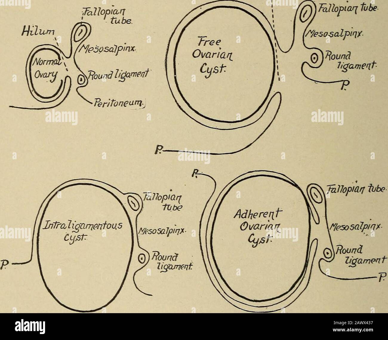 Gynecological diagnosis . w Formations. (a) Cystoma serosum simplex ...